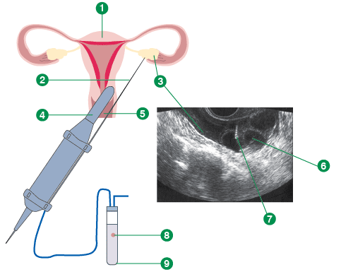 Ovulation and follicular puncture
