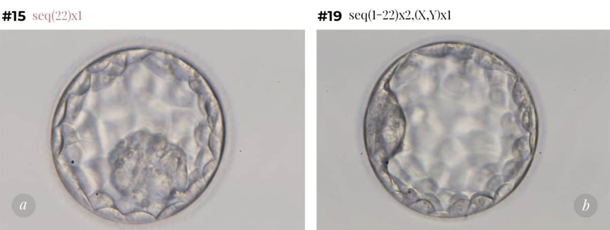 Chromosomal Screening of Embryos — PGT-A - O.L.G.A. Fertility